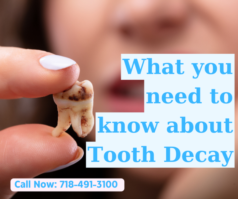 Understanding Tooth Decay: What You Need to Know